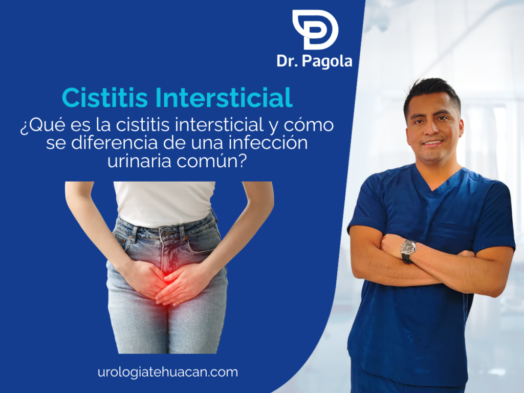Cistitis Intersticial - Urología Tehuacán